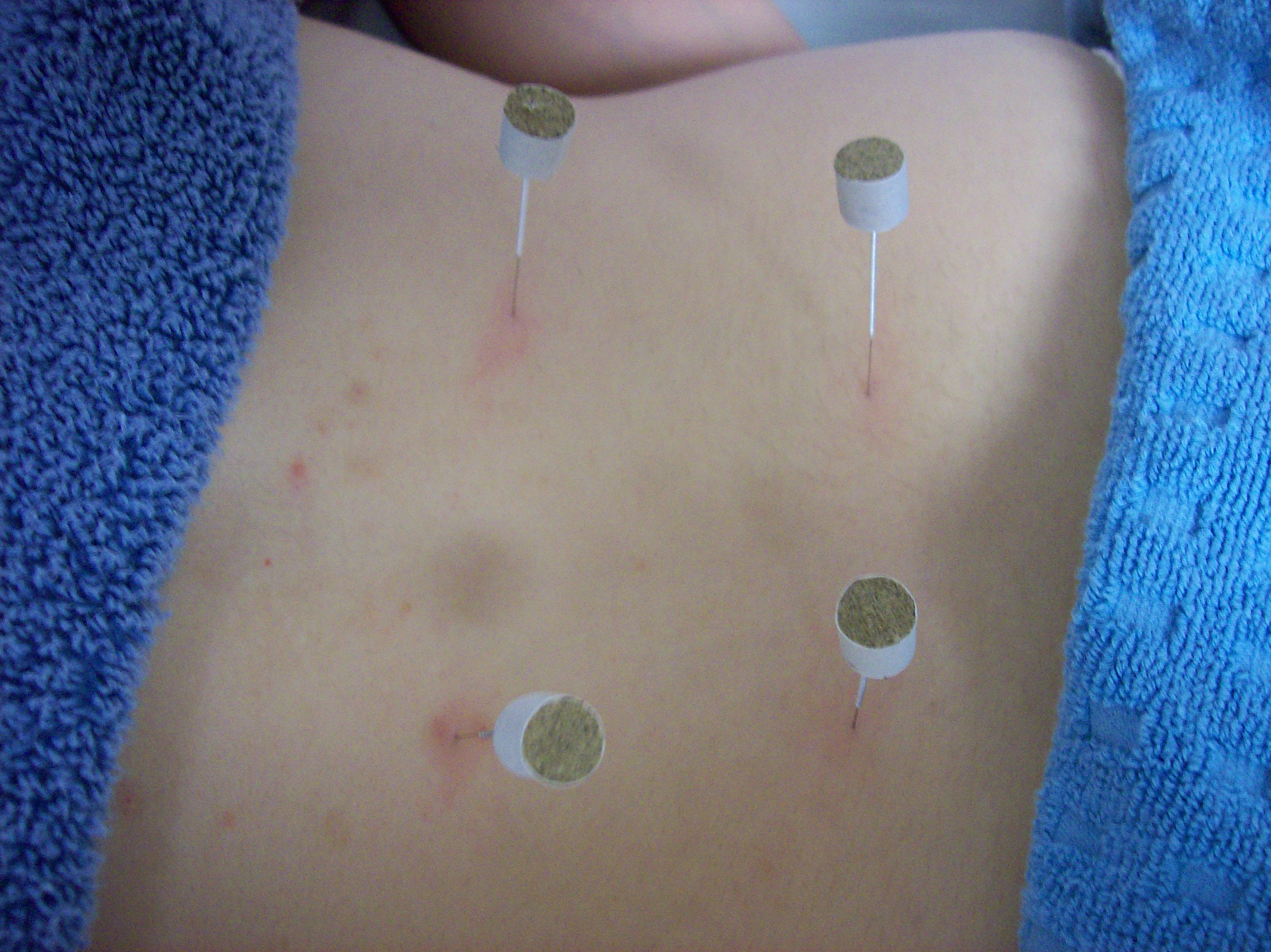 Introduction of moxibustion in traditional Chinese medicine